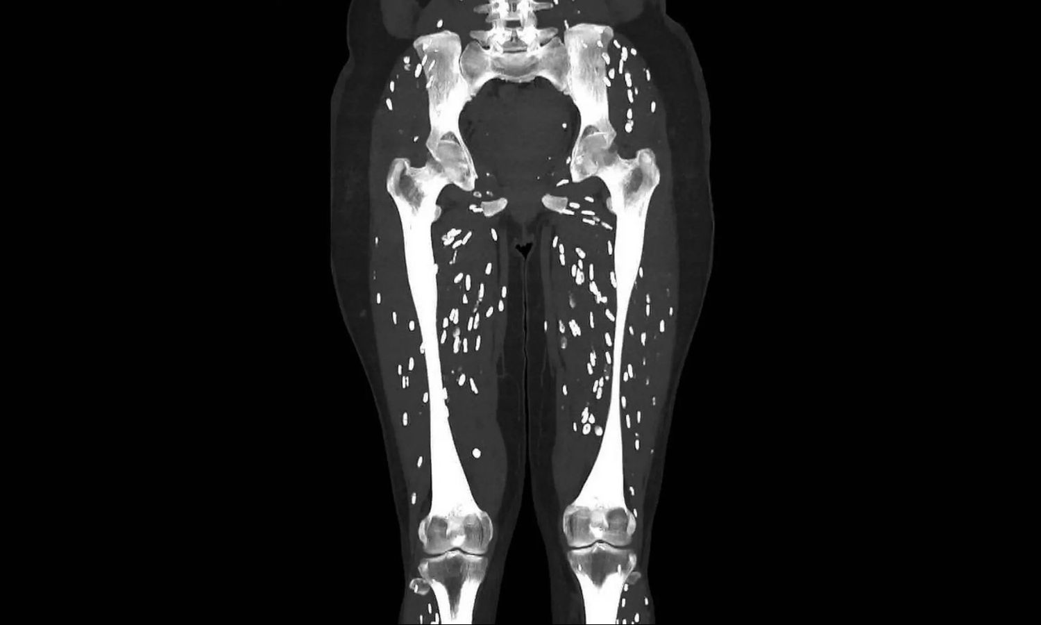 Doctor Shares Craziest CT Scan of Parasitic Infection Linked to ...