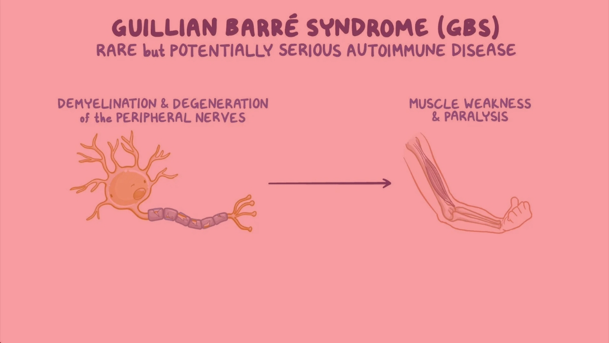 Telangana woman diagnosed with GBS disease, first known case in state