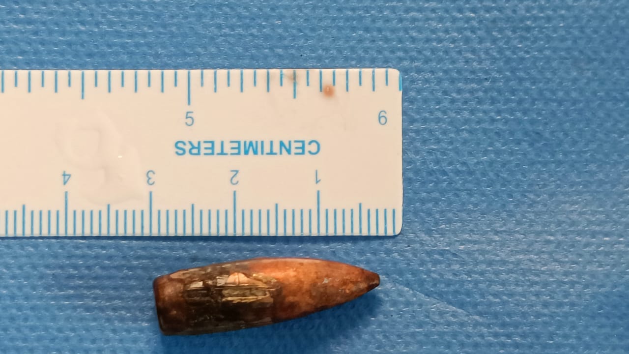 CARE Hospitals Successfully Performs Rare Bullet Removal Brain Surgery ...